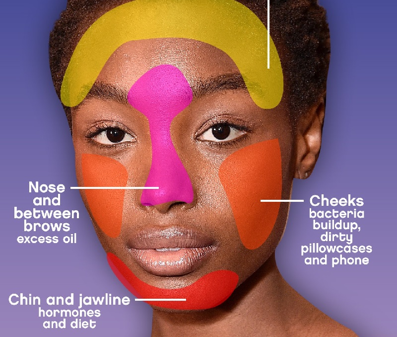 Bản đồ mặt mụn giúp xác định lý do bạn bị nổi mụn ở từng vị trí cụ thể